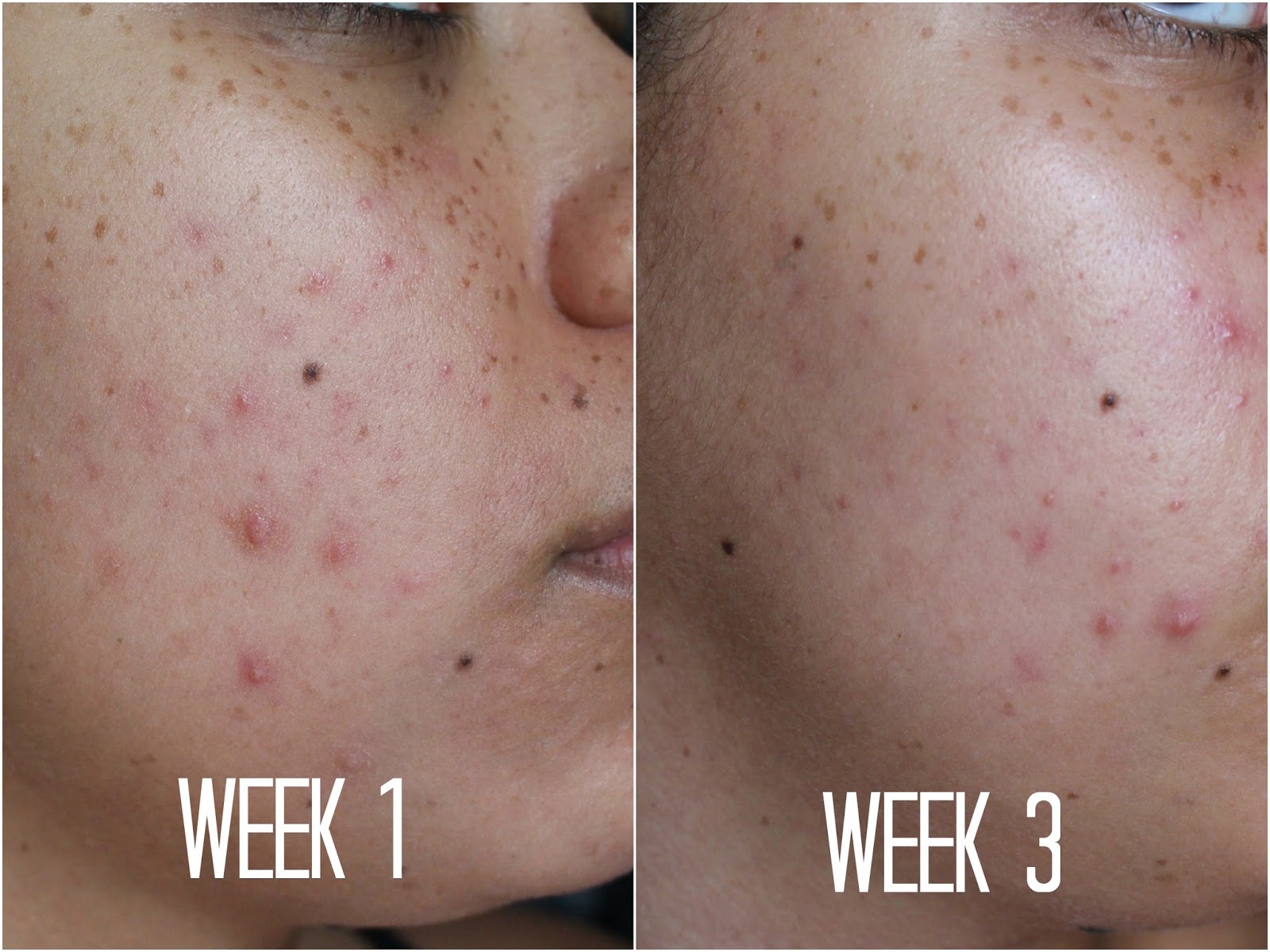 Samantha Jane: Reversa Solution for Oily and Acne Prone Skin