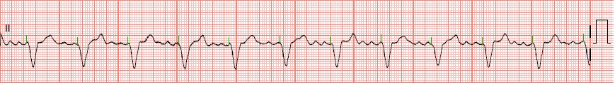 EKG Rhythm Strip Quiz 56: Paced Rhythms