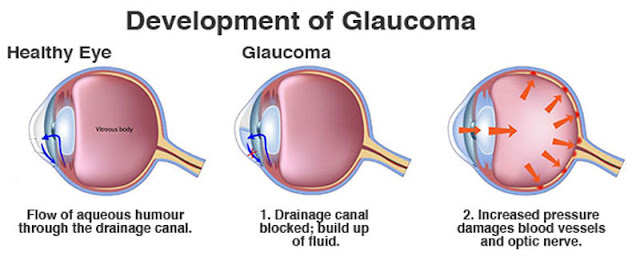 Let's Talk about Glaucoma Starting Today, Types of Glaucoma, Risk, Test ...