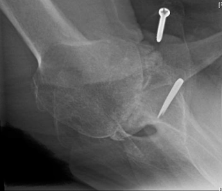 Ream and run for severe capsulorrhaphy arthropathy with retroversion