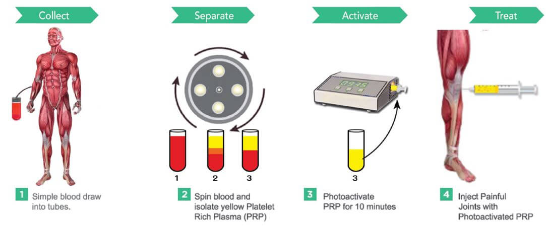 Megan's ACI Carticel Surgery: 2017