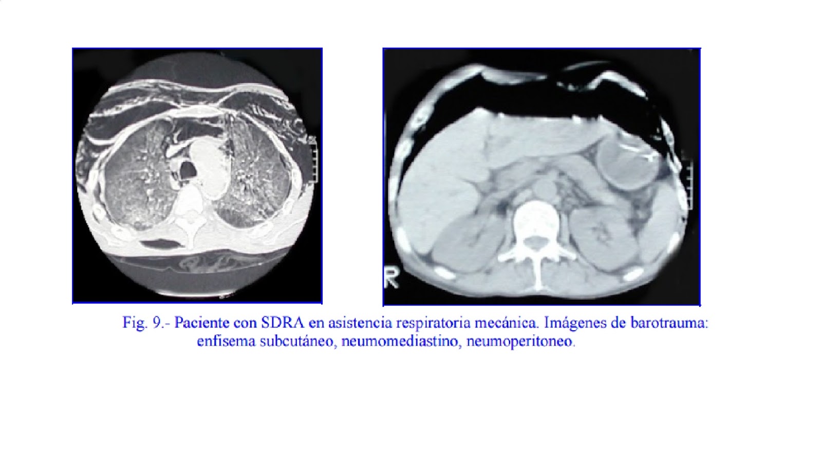 SDRA todo lo que necesitas saber!!: 2015