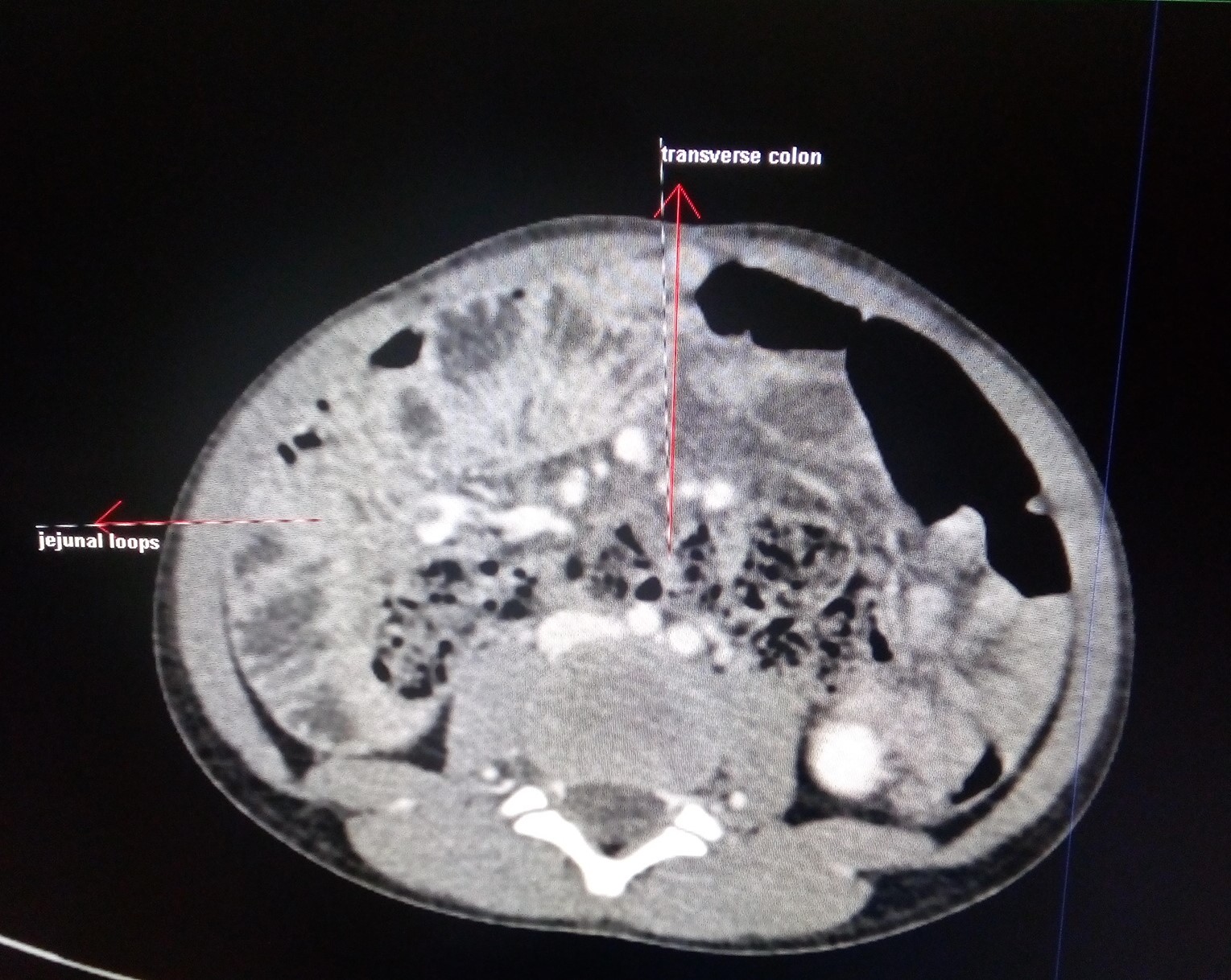 Midgut Volvulus CT - Sumer's Radiology Blog