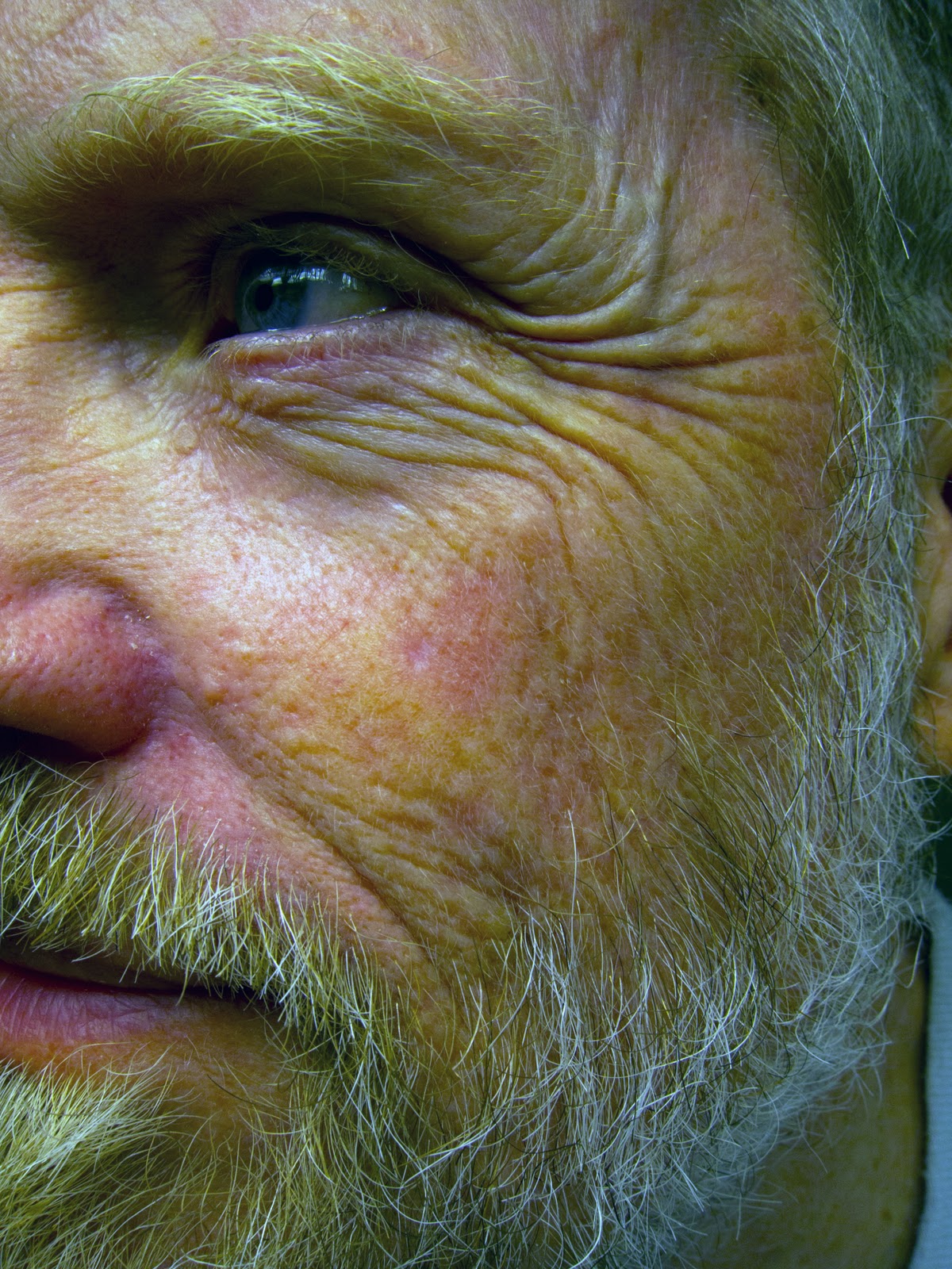 Efudex - Round Two: Day 86 (Recovery Day 72)