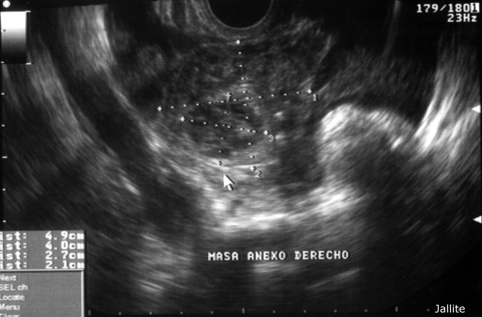 Embarazo Ectopico Vs Tumoracion Ovarica