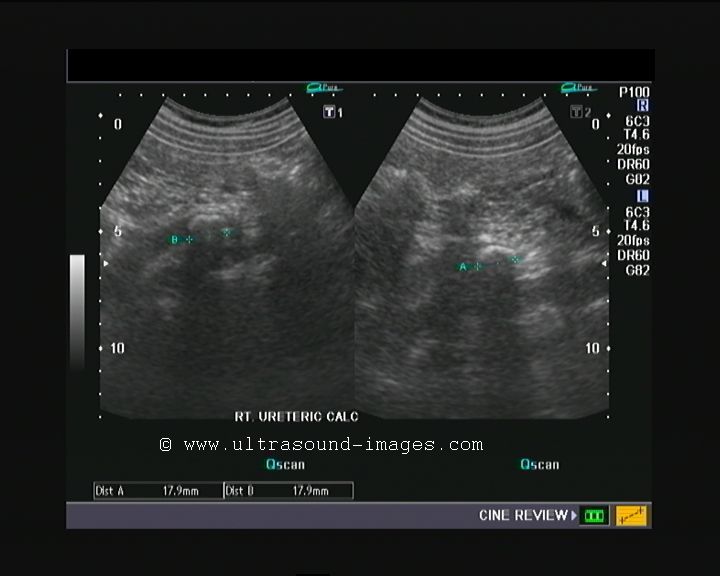 cochinblogs: Kidney stones- renal calculi- urinary stones