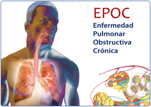 EPOC BRONQUITIS Y EFISEMA: EPOC ENFERMDAD PULMONAR OBSTRUCTIVA CRONICA