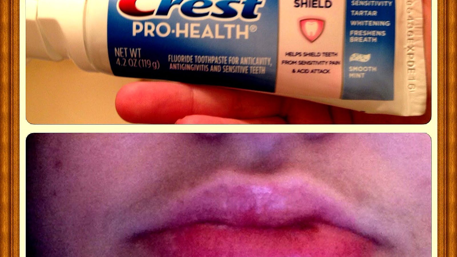 Mouth Ulcer Toothpaste - Ulcer Choices