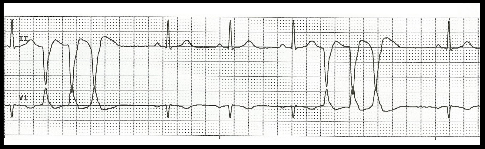 Practice EKG Rhythm Strips 167