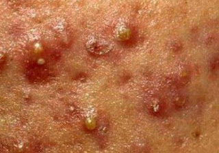 Drº. Acne: DESCOBRINDO A ACNE CAUSAS E TRATAMENTOS