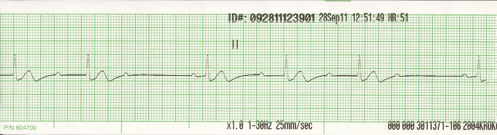 ACLS Rhythms: Heart blocks