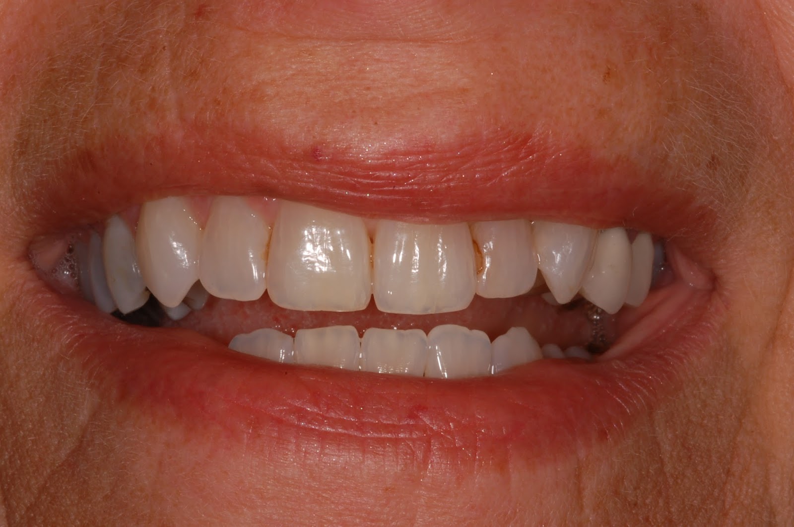 Old brown filling - Bauer Smiles