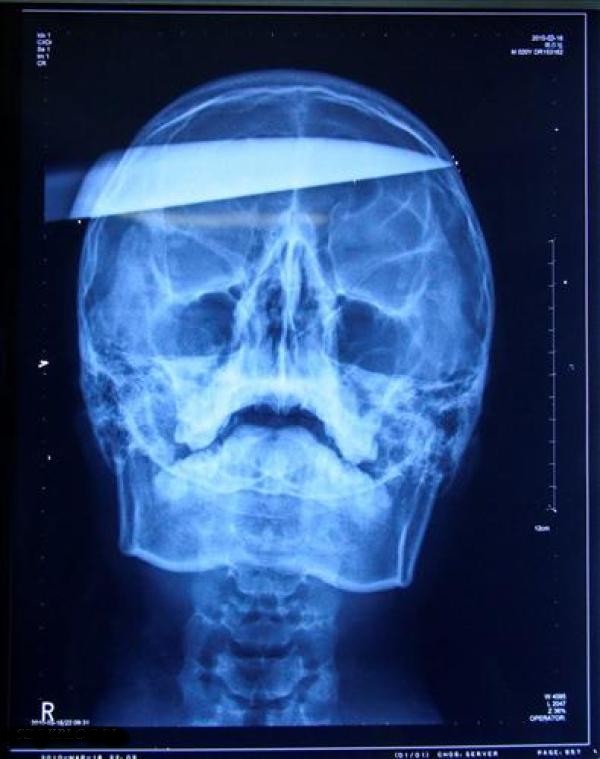 Deformutilation: Disturbing X-Rays