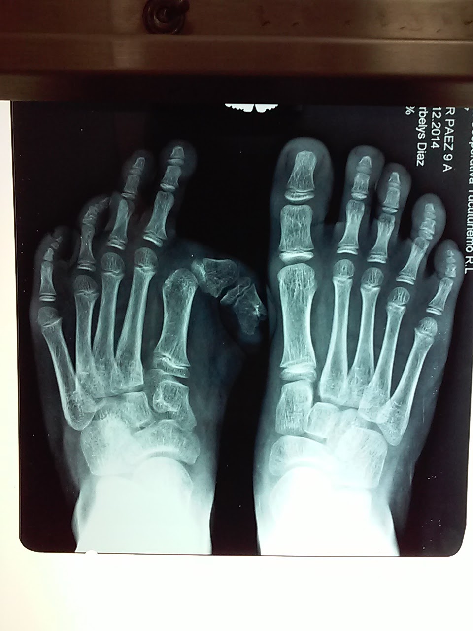 Caso clinico N° 5 Hallux varux congénito