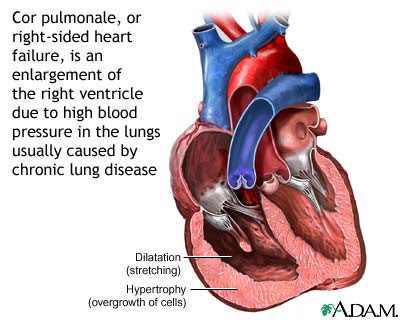Respiratory Therapy Cave: Impact of COPD on the heart