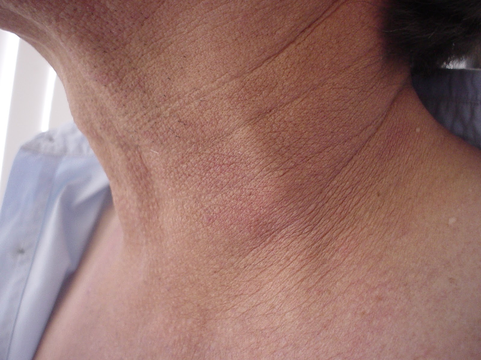 Trombosis Yugular y Axilar Formación del Trombo - Drenaje