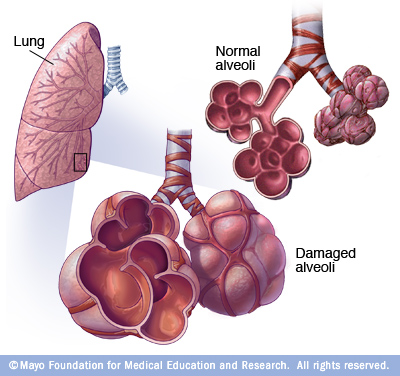 Respiratory Therapy Cave: What is emphysema?