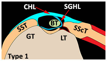 MRI Musculo-Skeletal Section: Long head of biceps dislocation grading.