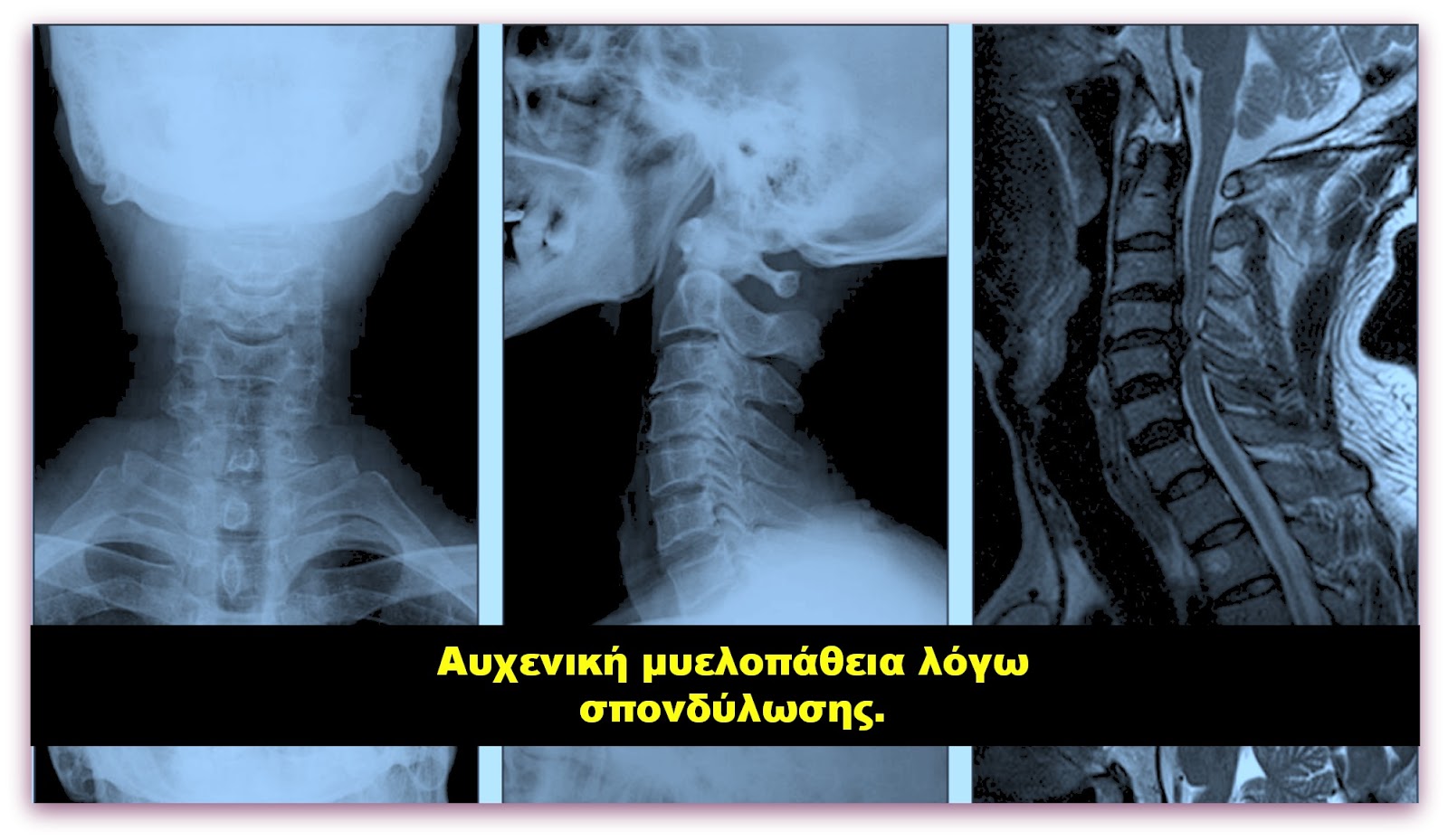 Κωνσταντίνος Χ. Δαβανέλος: Αυχενική Σπονδύλωση.