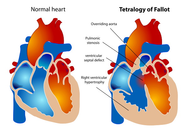 His Rare Case of CHD : Tetralogy of Fallot (ToF) with PA and MAPCAs ...