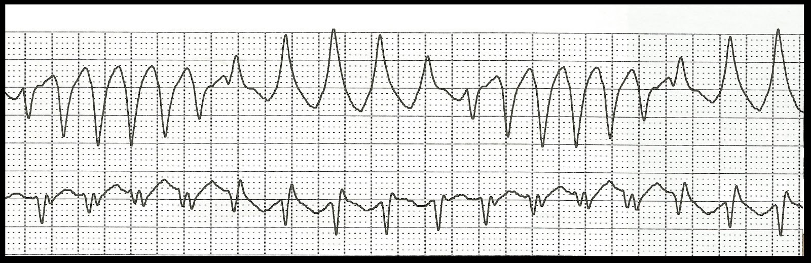 Pulseless VF/VT Part 1