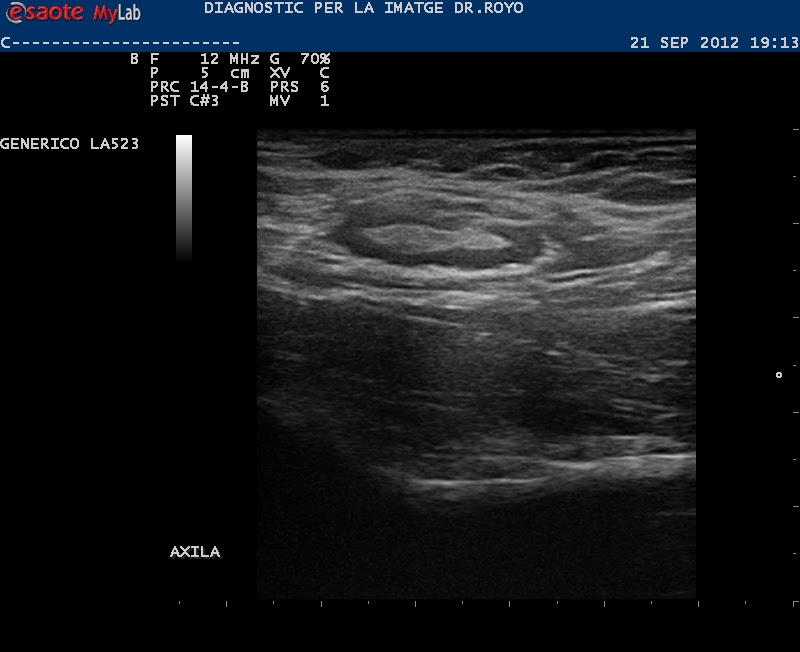 Mamografías Lleida. Unidad de Diagnóstico de Patología Mamaria: ESTUDIO ...