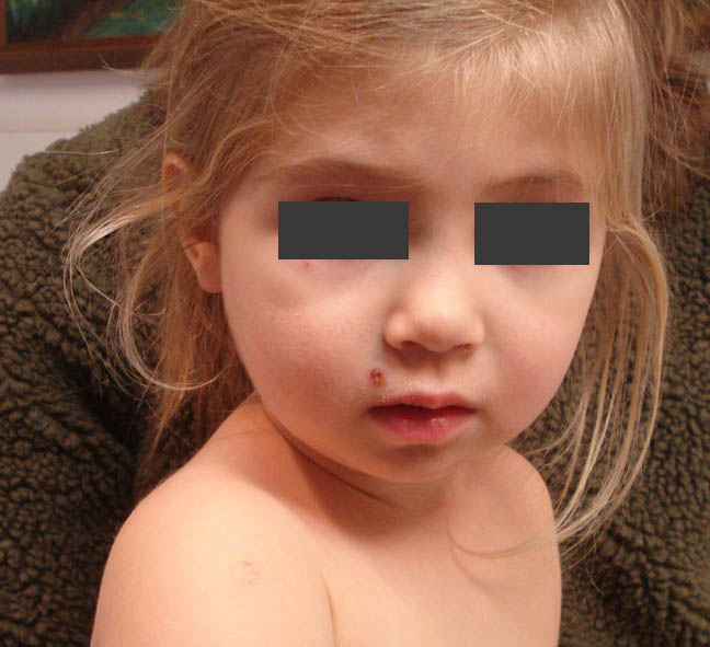 VIRTUAL GRAND ROUNDS IN DERMATOLOGY 2.0: Two year-old with enanthem and ...