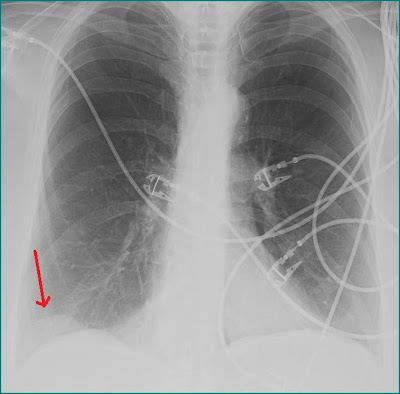 What is the cause of this chest x-ray opacity? | little white coats