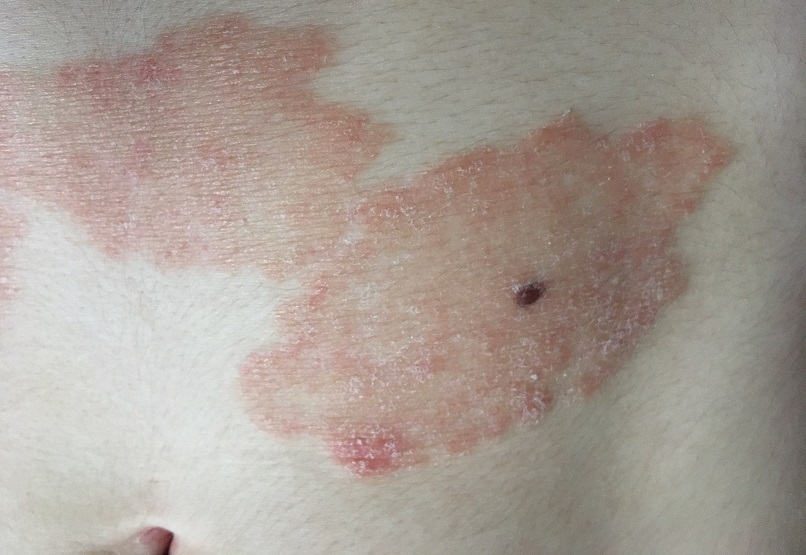Psoriasis fading in spots
