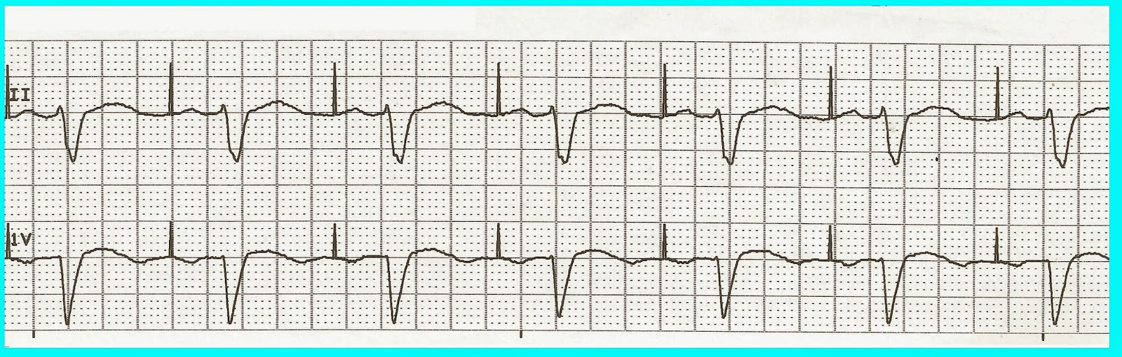 Practice EKG Rhythm Strips 210