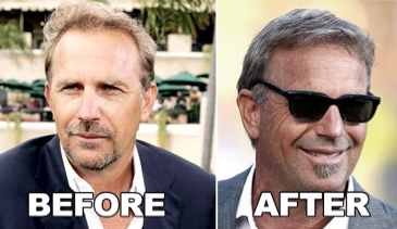 Kevin Costner Hair Transplant