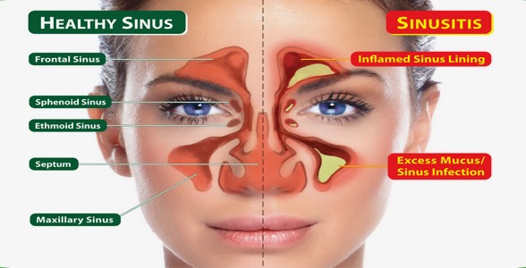 พึ่งพรเภสัช.. ร้านยาของครอบครัวคุณ: ไซนัสอักเสบ (Sinusitis)