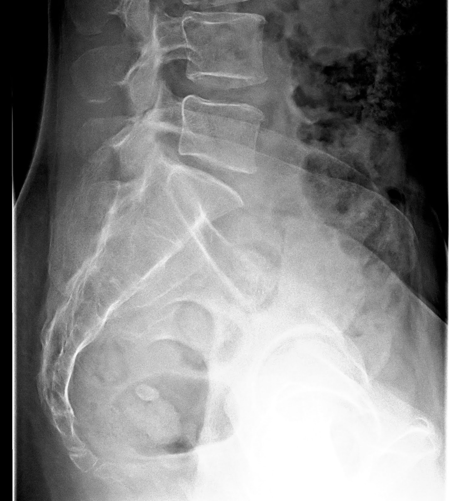 Raio X Coccix Normal - BRAINCP