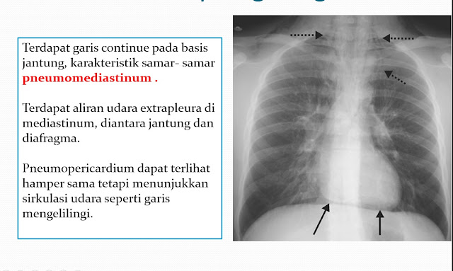 Indikasi thorax PA pneumomediastinum, extrapleura, Pneumopericardium