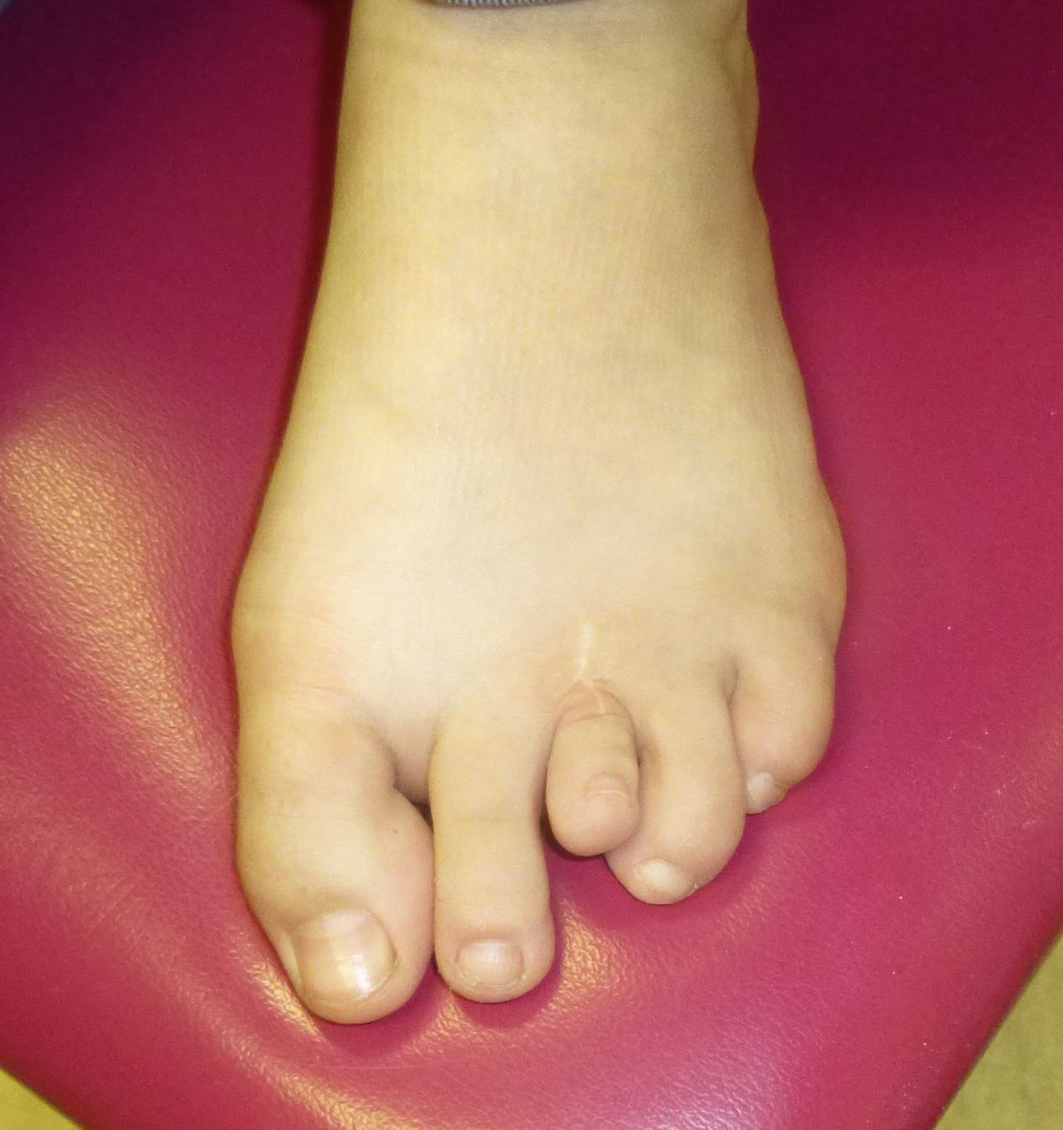 Congenital Hand and Arm Differences: May 2013