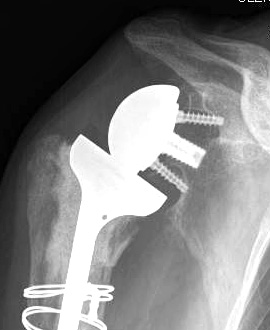 UW Shoulder and Elbow Academy: Reverse total shoulder - progressive ...