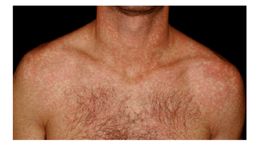 Mono Rash Pictures | Medical Pictures and Images - (2023 Updated)