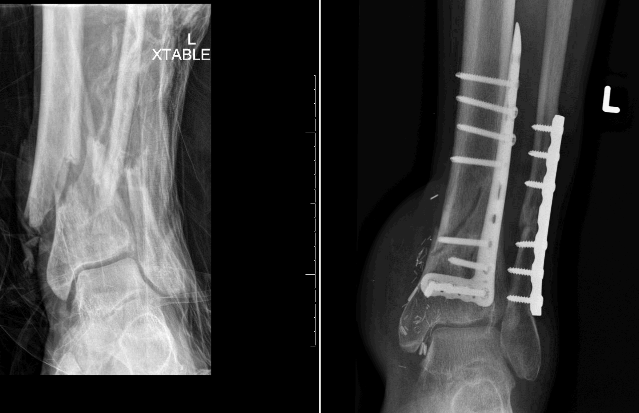 Distal Tibia Pilon Fractures New York Fracture Care - vrogue.co Distal Tibia Pilon Fractures New York Fracture Care - vrogue.co