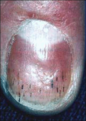 Simple Cardiology: - Peripheral Signs of Infective Endocarditis.