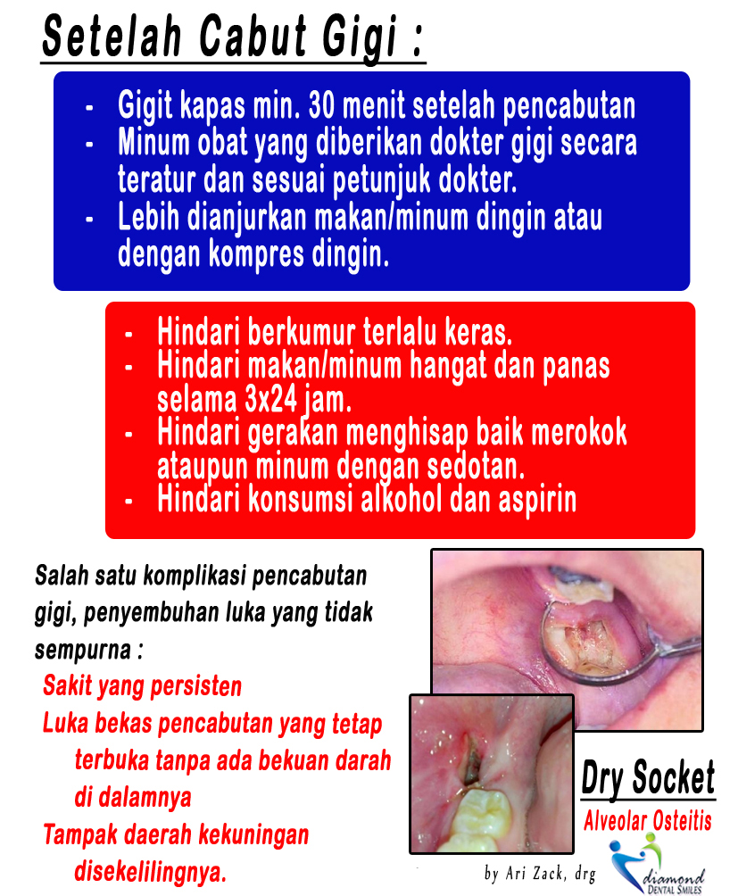 Mengenal Gigi Impaksi : Apa, Mengapa dan Bagaimana