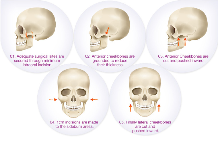 Eyelid Surgery Legend Dr. Kim Byung Gun: [BK Plastic Surgery Hospital ...