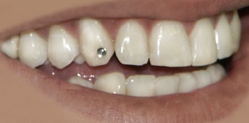 Ortodontia é Arte: Piercing dental