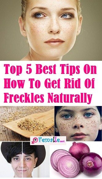 How to Get Rid of Freckles Naturally and Fast