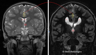 El Baúl Radiológico: DISGENESIA DEL CUERPO CALLOSO: HALLAZGOS EN TC e ...