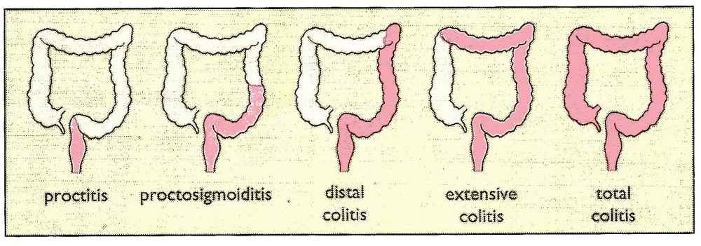 How does Ulcerative Colitis affect the gut ? - ulcerative colitis treatment