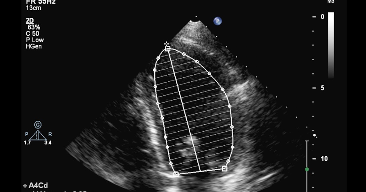 Andrew R Houghton Is A Left Ventricular Ejection Fraction Of 50 Andrew R Houghton Is A Left Ventricular Ejection Fraction Of 50