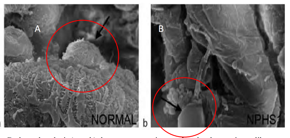 ABOUT: Lectur: Kuliah Glomerulopati pada Anak (DR. Dr. Omega Mellyana ...