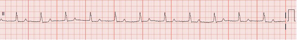 EKG Rhythm Strips 14: Junctional Rhythms