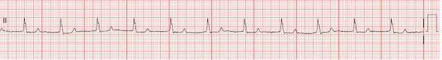 EKG Rhythm Strips 14: Junctional Rhythms