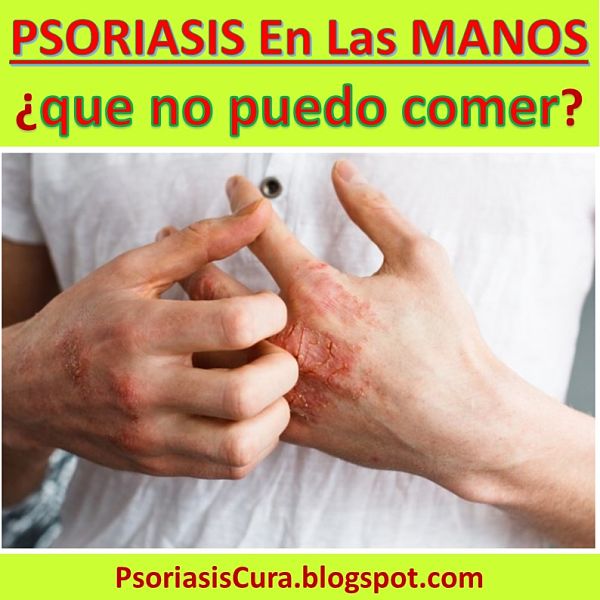 Psoriasis Cura